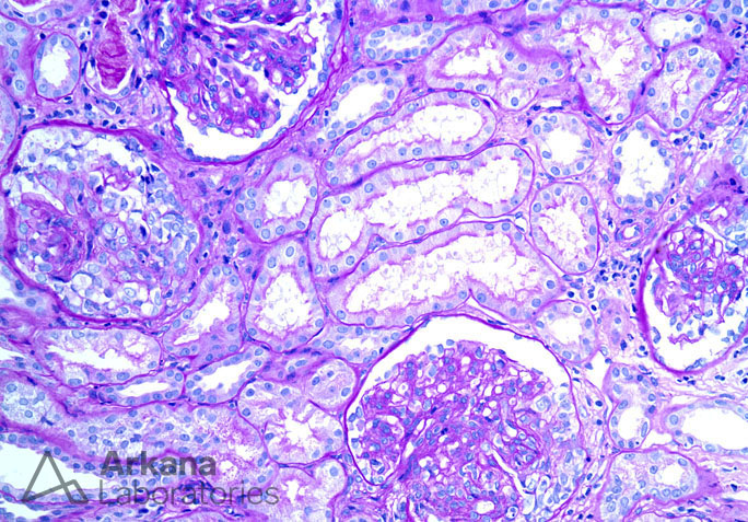 Endocapillary Proliferation and Crescent Formation in Lupus Nephritis ...