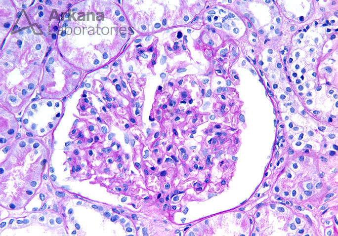 Enlarged Glomerulus with a FSGS Tip Lesion on PAS – ISMMS Nephrology ...