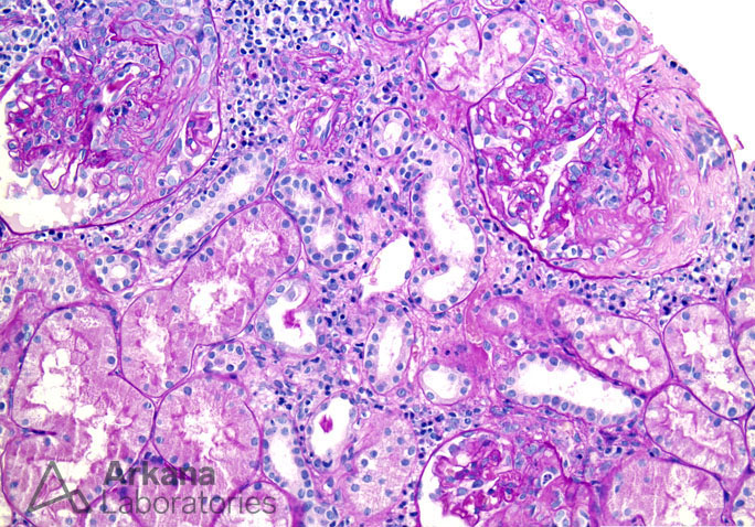 Fibrocellular Crescent Formation and Interstitial Inflammation in Lupus ...