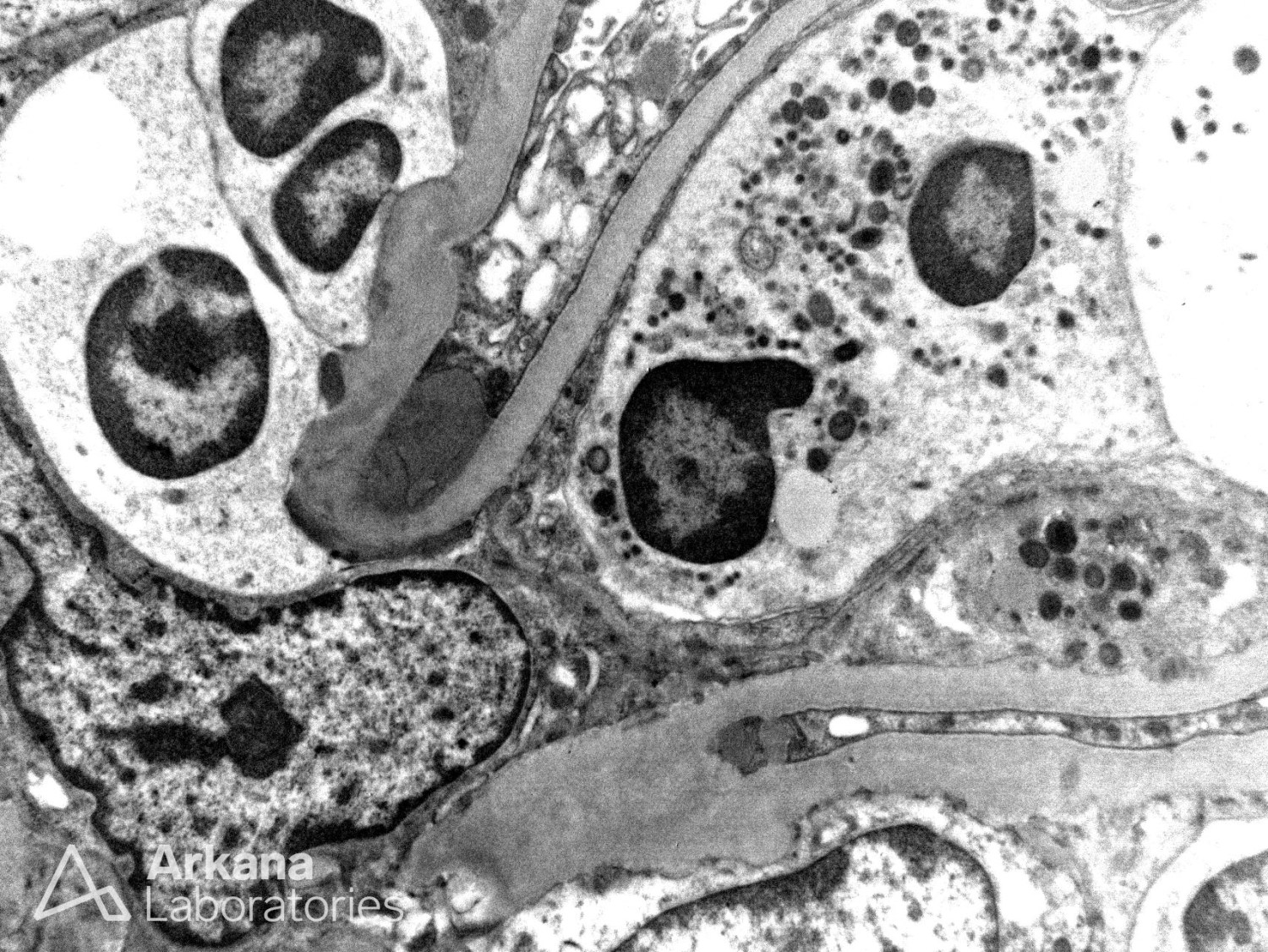 Hinge-Region Immune Complex Deposit – ISMMS Nephrology Fellowship