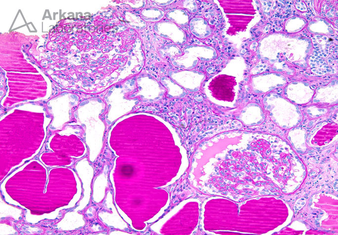 Idiopathic Collapsing Glomerulopathy and Microcystic Tubular Dilitation ...