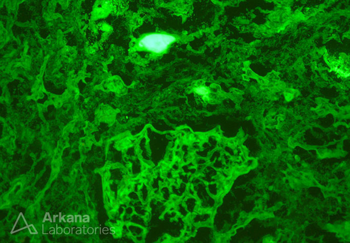 Light Chain Casts with Negative Staining on Lambda – ISMMS Nephrology ...