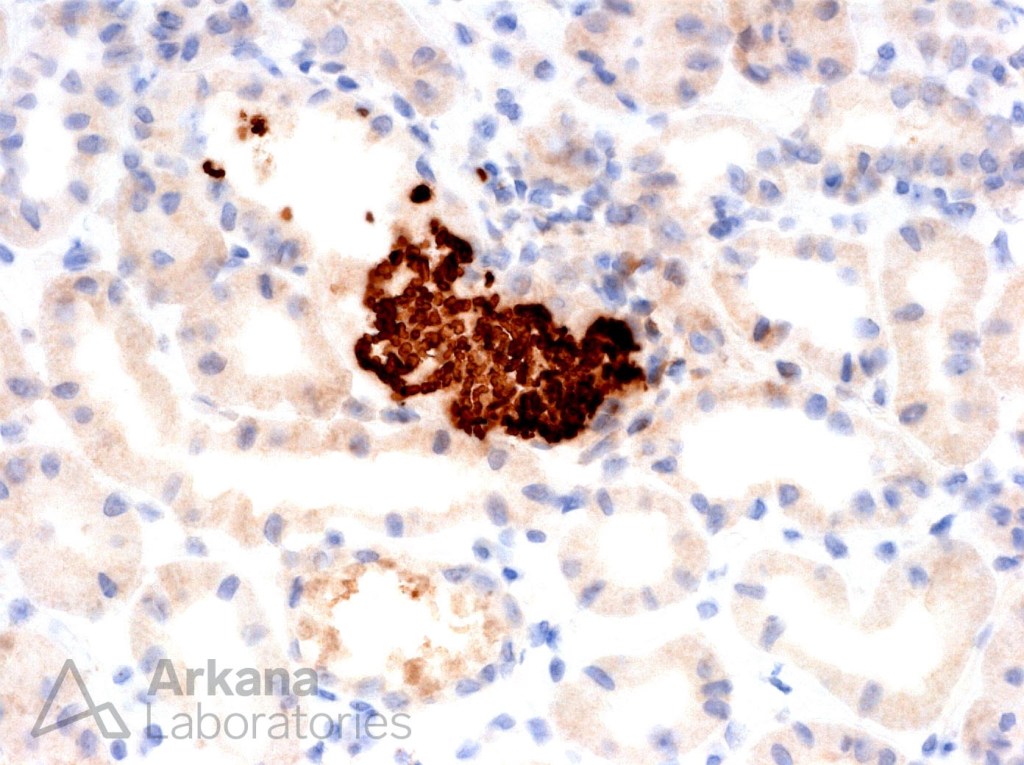 Myoglobin IHC Stain with Positive Staining in Cast – ISMMS Nephrology ...