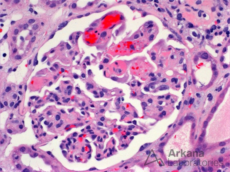 RBC Fragments, Mesangiolysis and Fibrin Thrombi in TMA – ISMMS ...