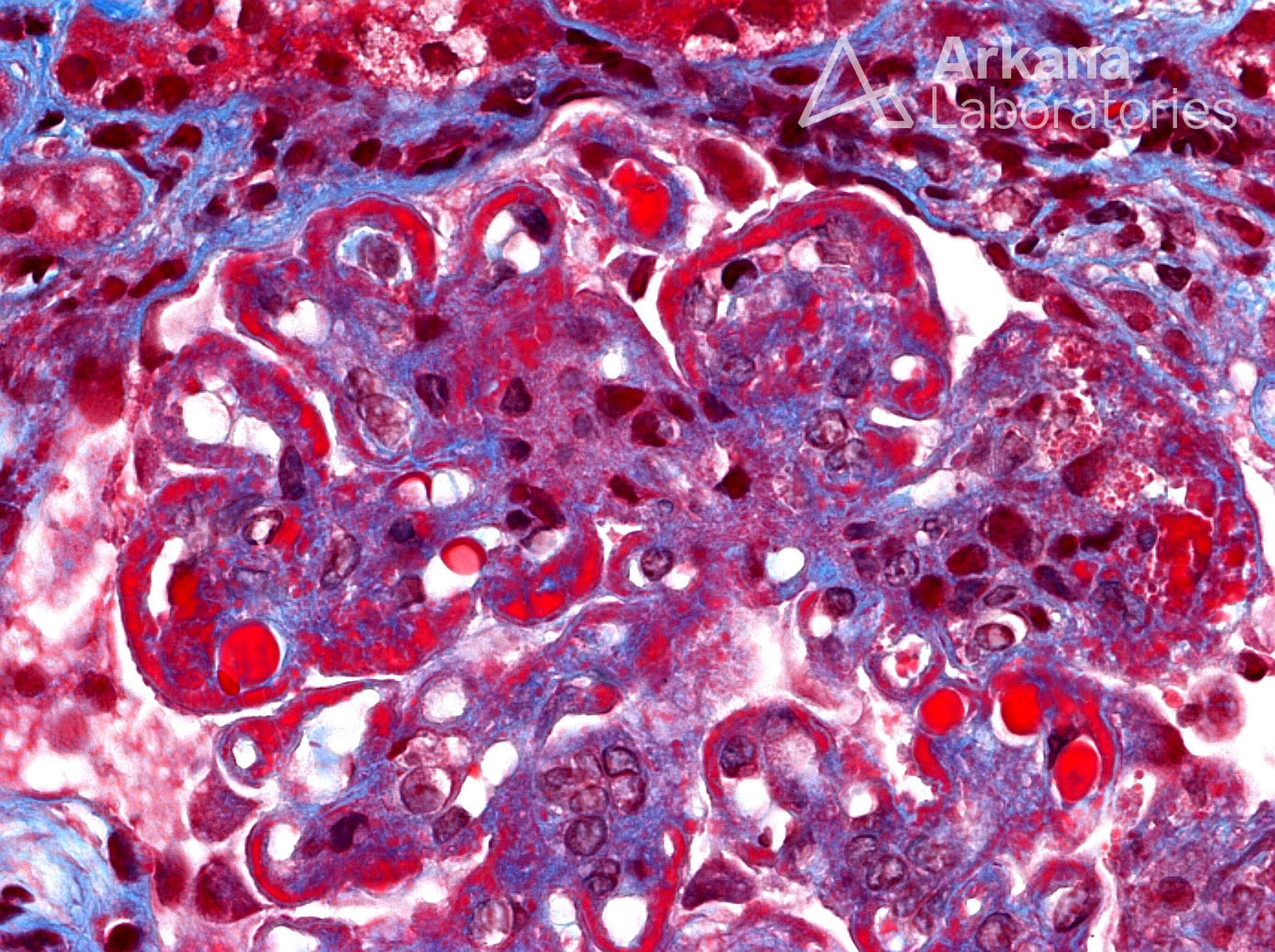 Wire Loop Formation in Lupus Nephritis on Trichrome Stain – ISMMS ...
